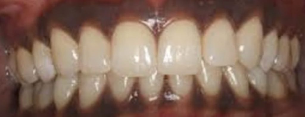 Why Are My Gums Dark Purple? – Vitamin Resource